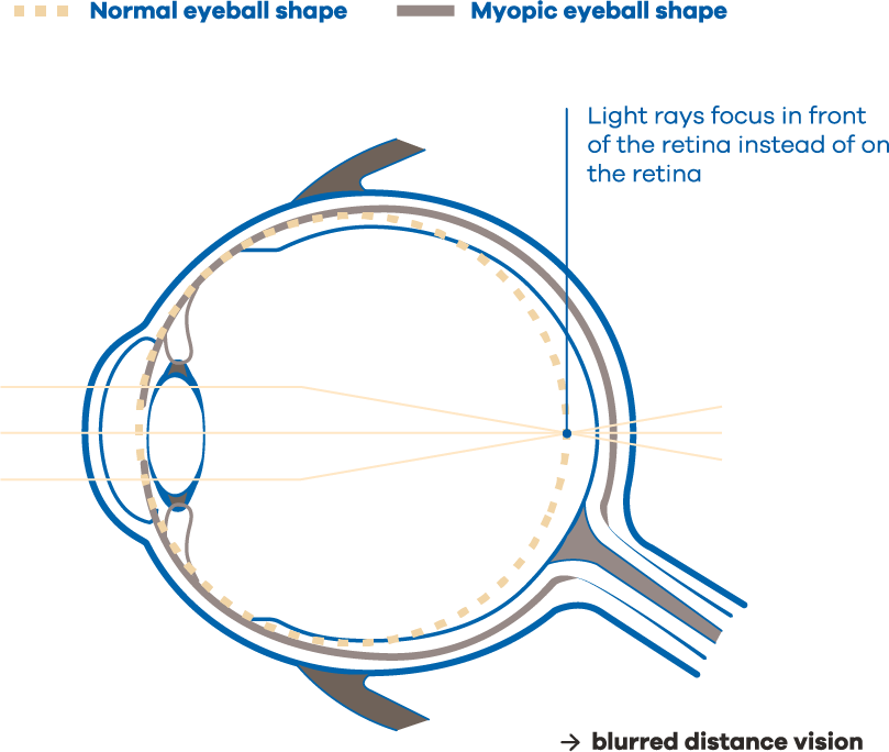 MiyoSmart | Hoya Vision